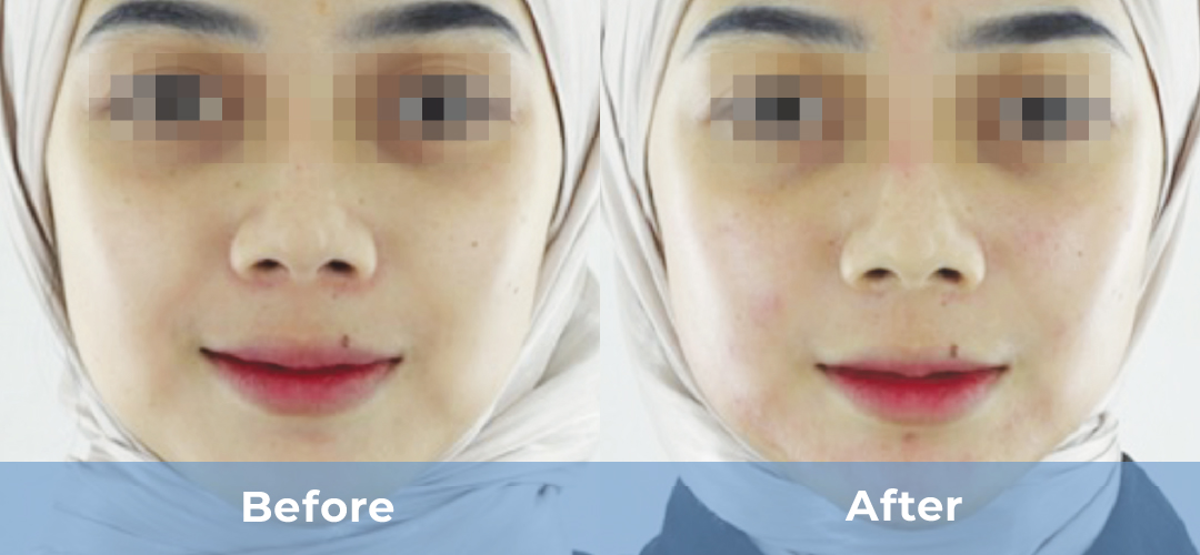 Botox & Filler – Maharis Clinic